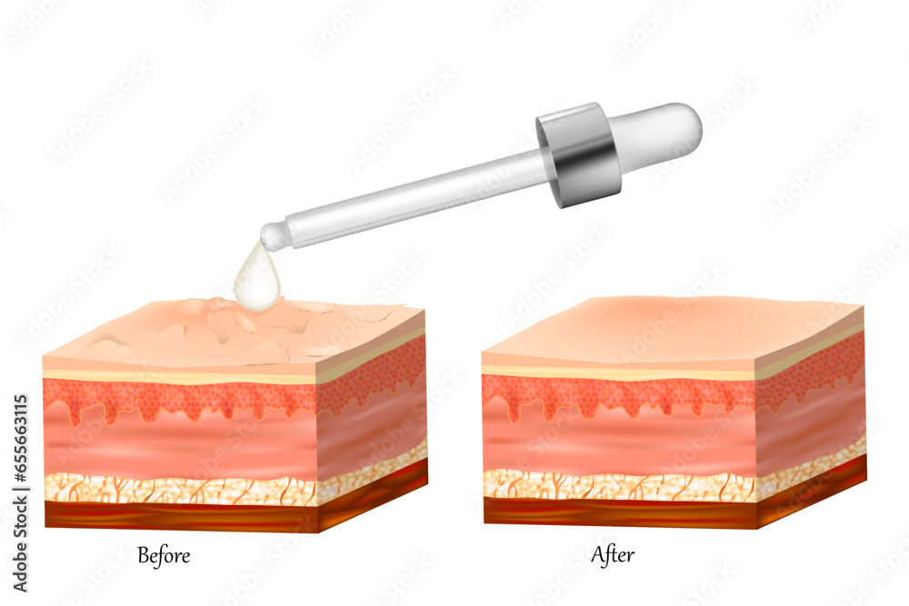 Realistic vector illustration with Healthy and damaged skin. Hydrated ...