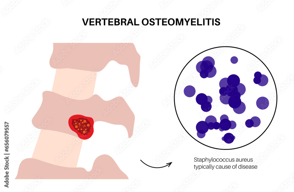 Vertebral osteomyelitis poster Stock Vector | Adobe Stock
