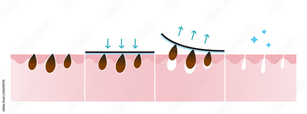 Blackhead removal process vector illustration isolated on white ...