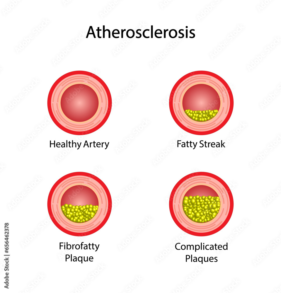 Atherosclerosis Stages, normal artery versus narrowed artery blocked ...