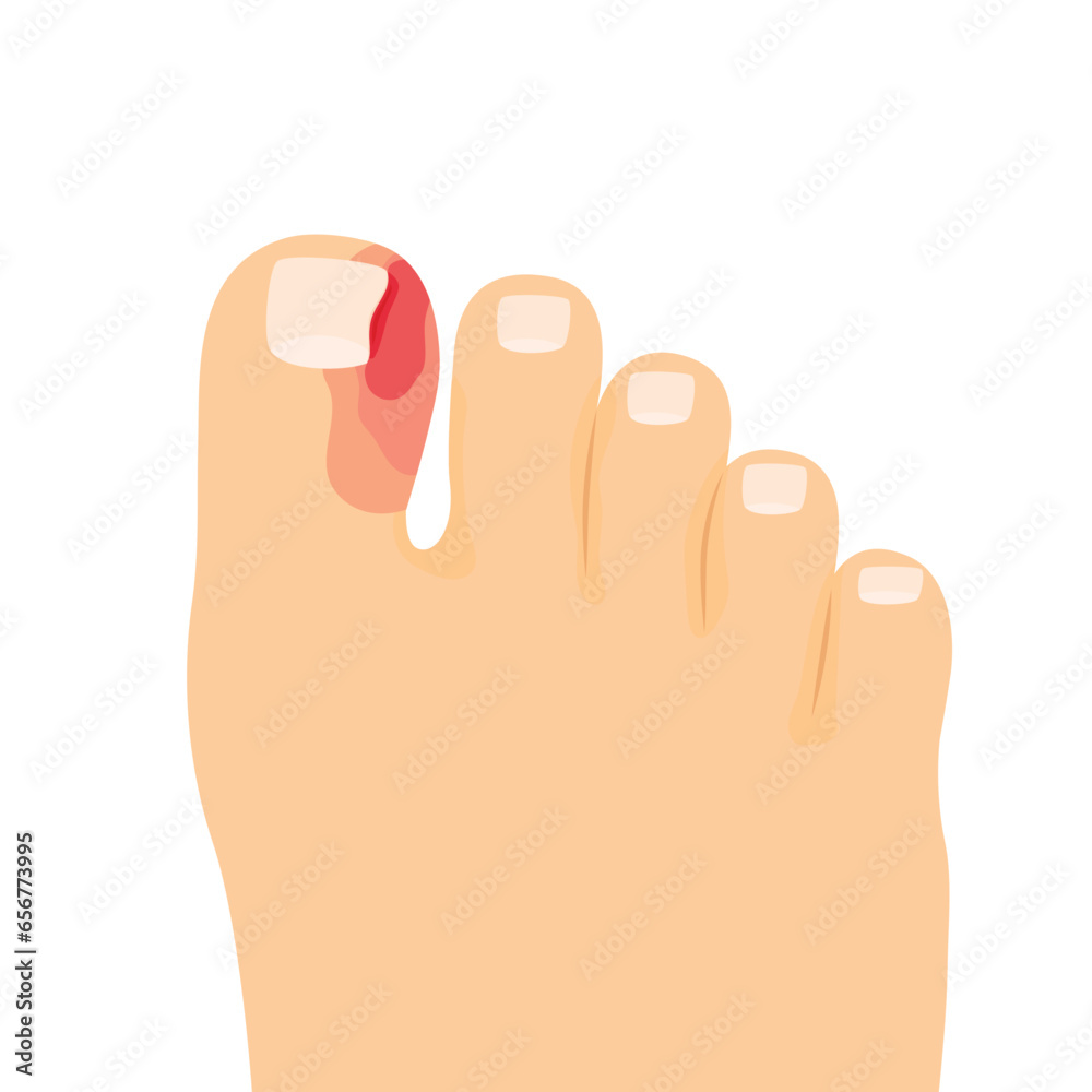 ingrown toenail, paronychia of the toe- vector illustration Stock ...