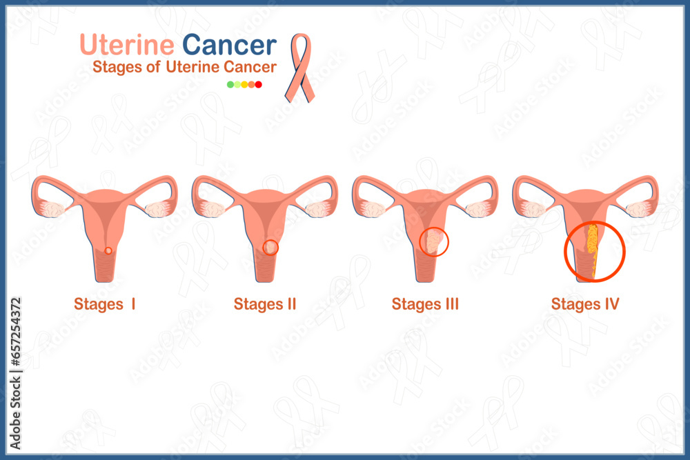 Flat medical vector illustration concept of 4 stages of uterine cancer ...