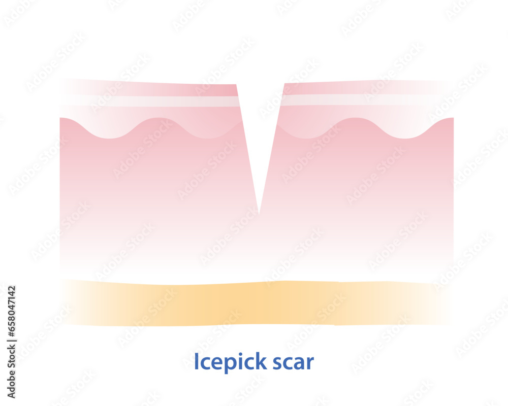 Cross section of icepick scar vector illustration isolated on white ...