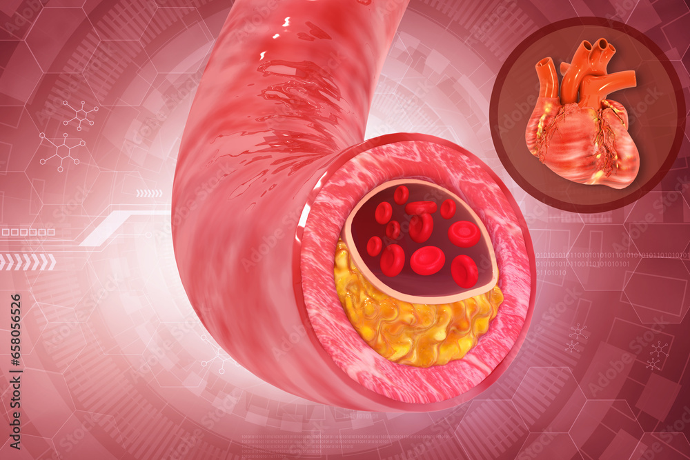 Blocked arteries with human heart diagram. 3d illustration.. Stock ...