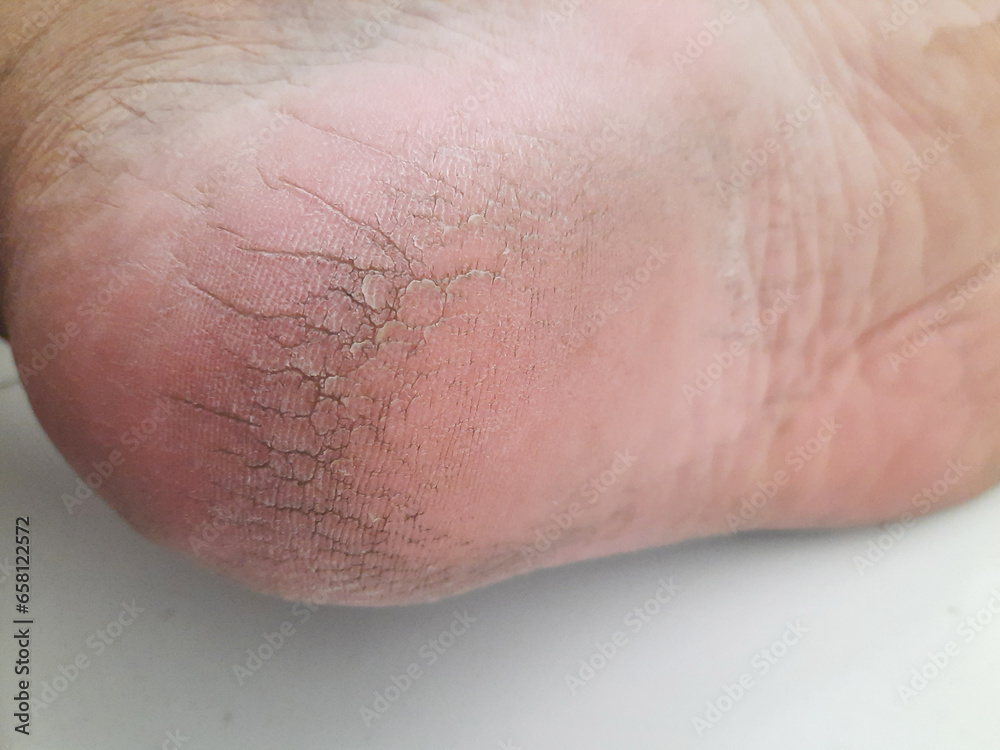 Heel fissures, or cracked heels, happen when the skin on the bottom of ...