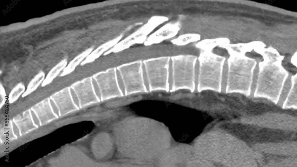 Real Tomography Diagnostic of patient with osteoporosis, pain in the ...