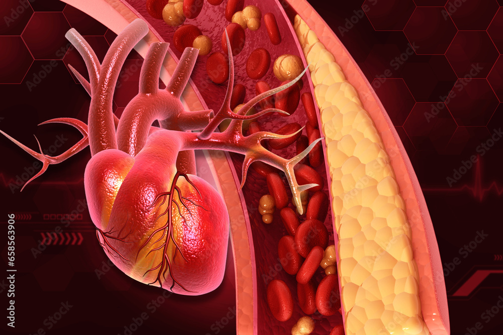 Blocked arteries with human heart diagram. 3d illustration. Stock ...