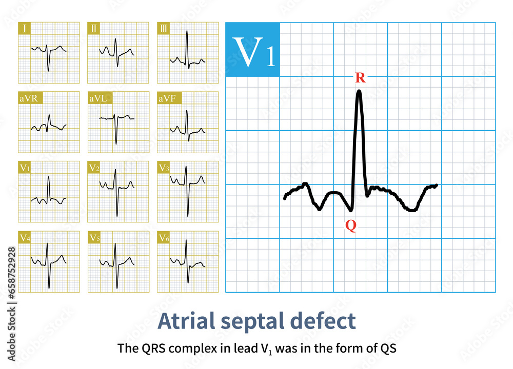 Male, 13 years old, clinically diagnosed with secundum atrial septal ...