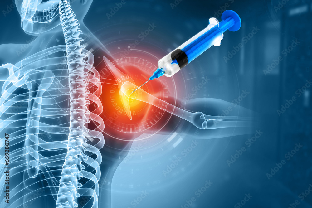 Shoulder Joint Injection, shoulder joint pain, x-ray view, shoulder ...