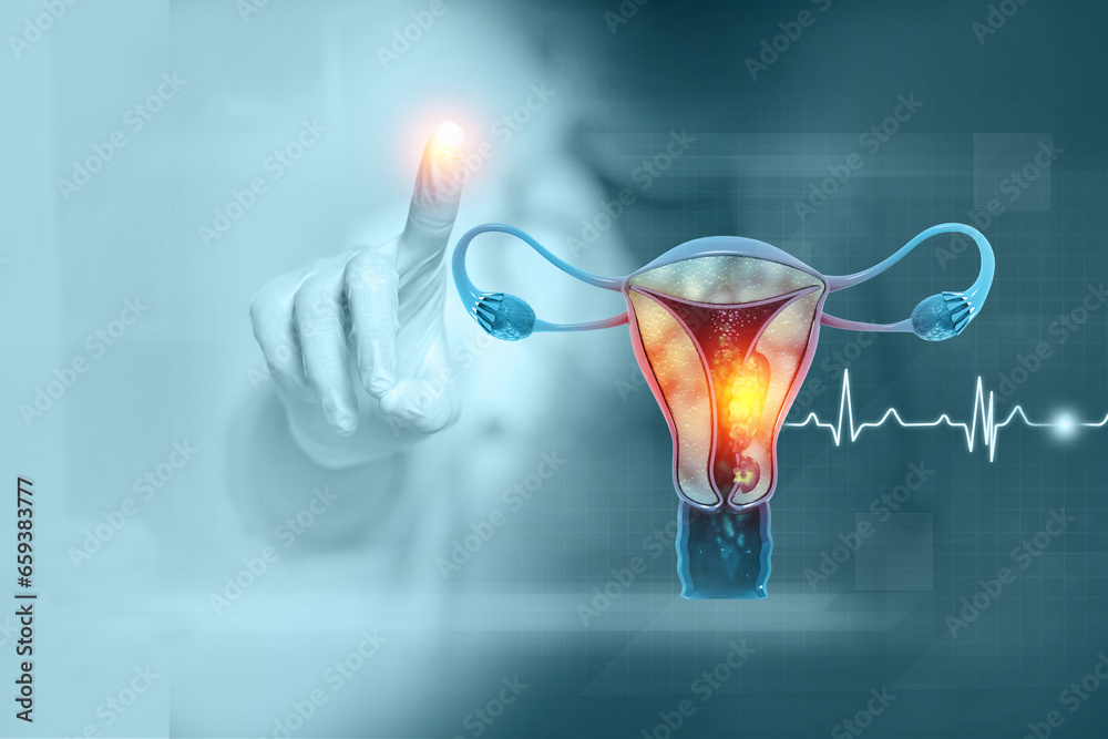 Female reproductive system diseases. Uterus cancer and endometrial ...