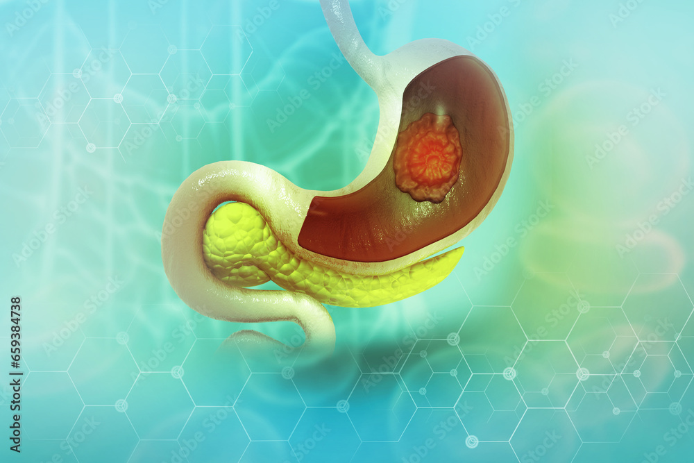 Stomach cancer. Cancer attacking cell. Stomach disease concept. 3d ...