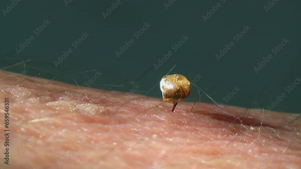 Bee's venom sac. Honey bee stings a man's arm. When the sting is over ...