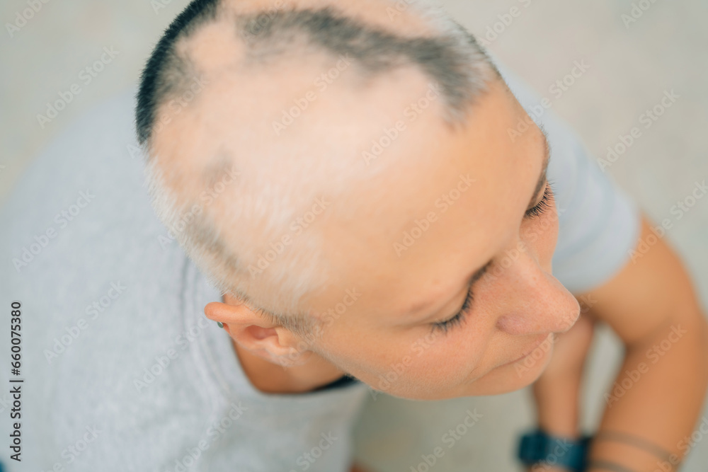 Real alopecia areata in a young girl. A bald head in a person. Diffuse ...