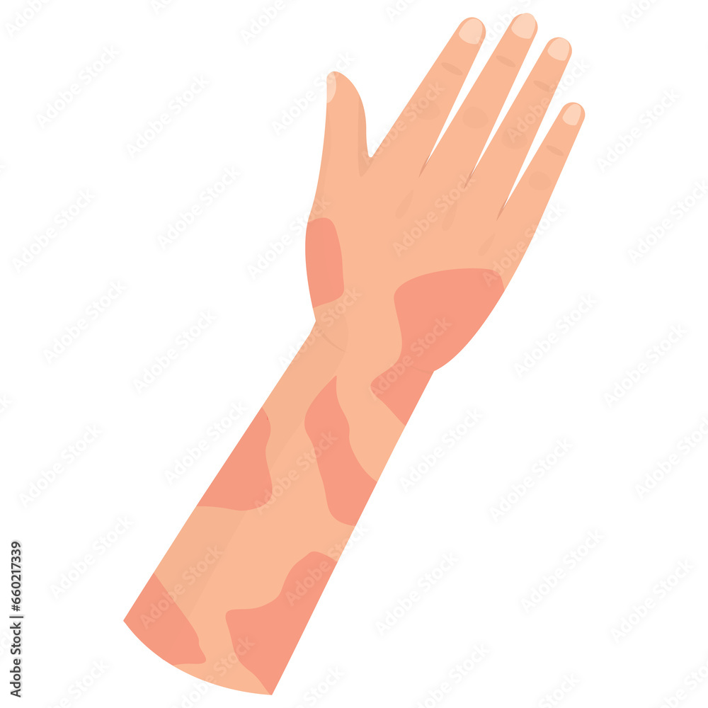 Vector illustration of burns on hands. Colored vector for website ...