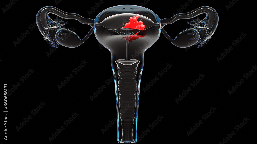 Reproductive system, cancer cells, ovaries cysts, cervical cancer ...