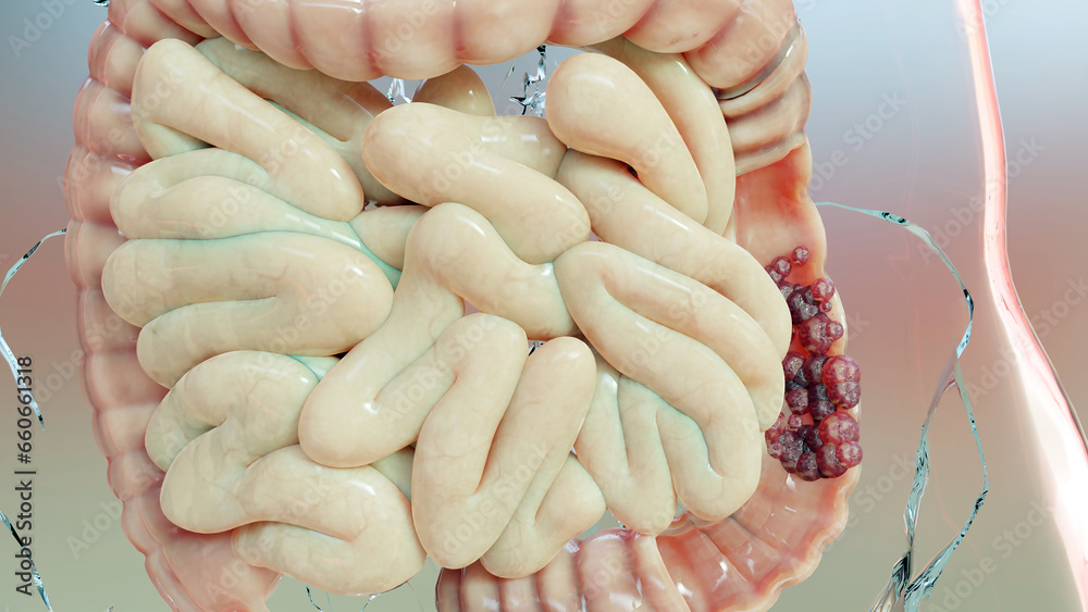 Colorectal cancer, malignant tumor in intestine, Endoscope inside ...