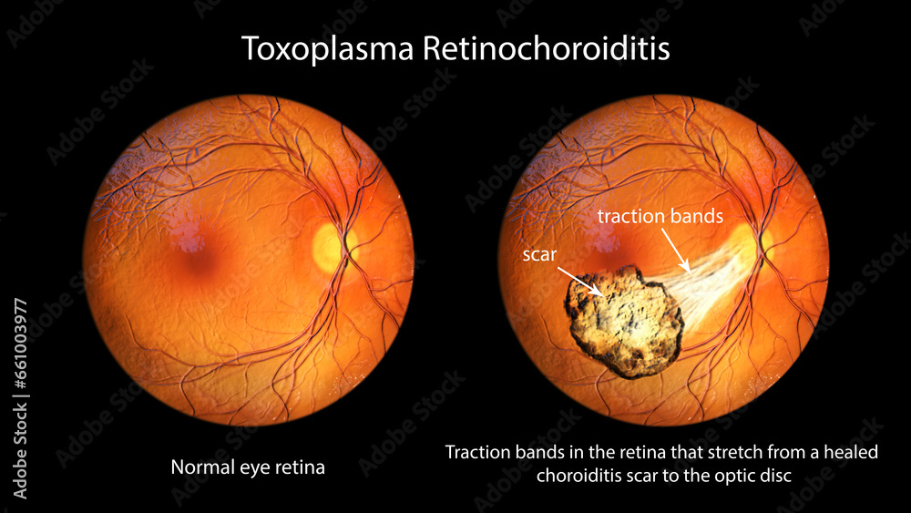 Toxoplasma retinochoroiditis observed during ophthalmoscopy, 3D ...