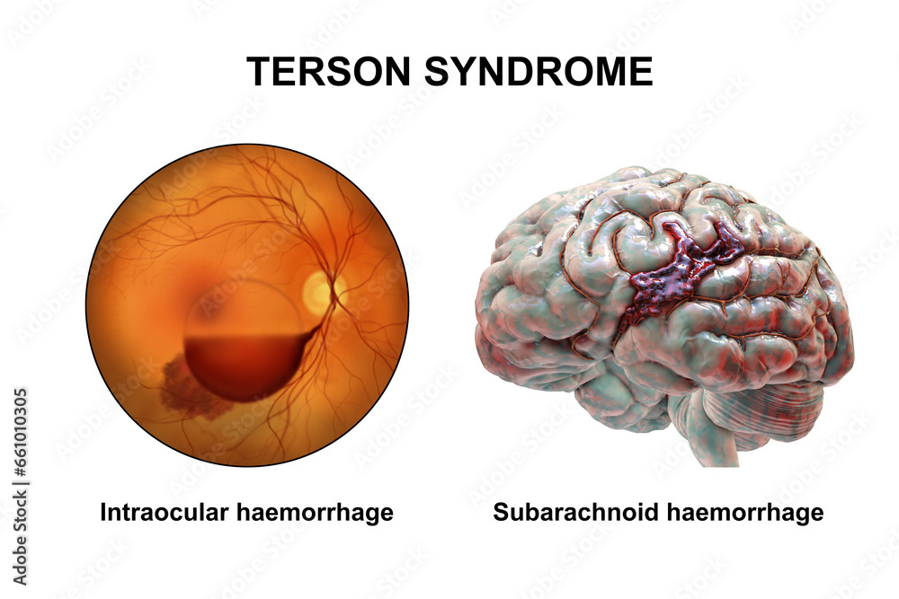 A 3D illustration of Terson syndrome, revealing intraocular hemorrhage ...