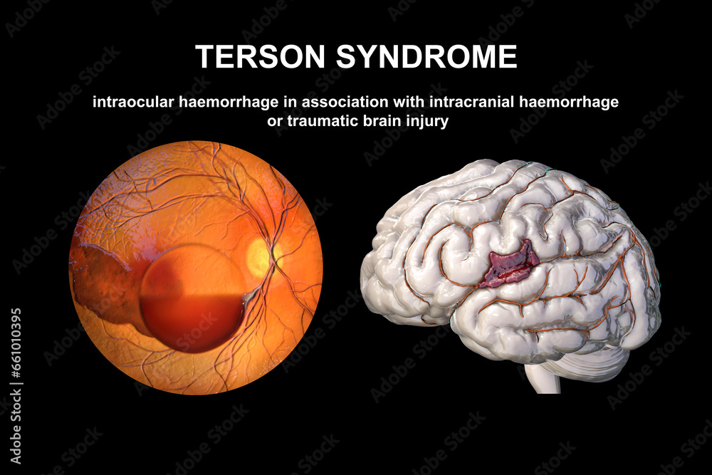 A 3D illustration of Terson syndrome, revealing intraocular hemorrhage ...