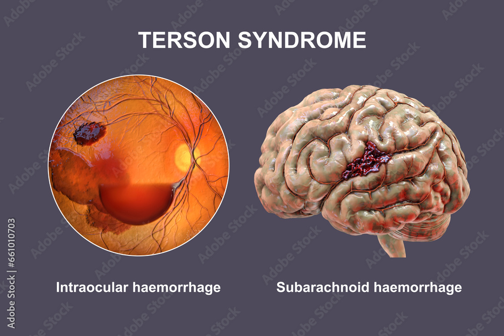 A 3D illustration of Terson syndrome, revealing intraocular hemorrhage ...