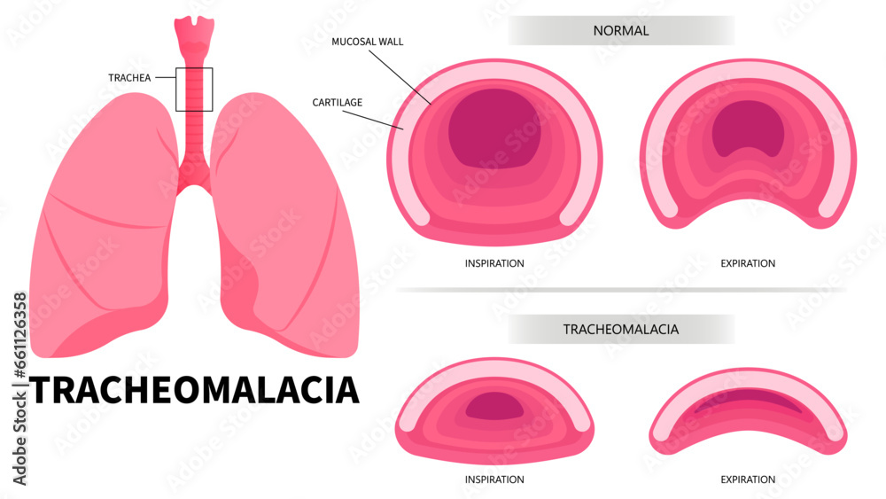 Lung anatomy with trachea exhalation inhalation breathe in common cold ...