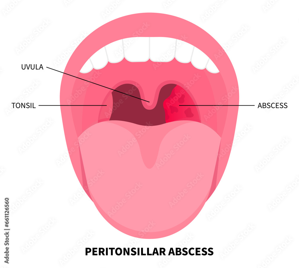 Throat abscess swelling of tonsil gland that cause by bacterial ...