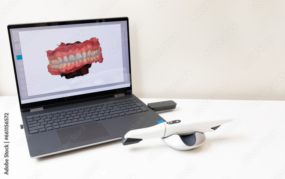 3D Scanned Picture of Scanned Teeth on Monitor of Computer, Notebook ...