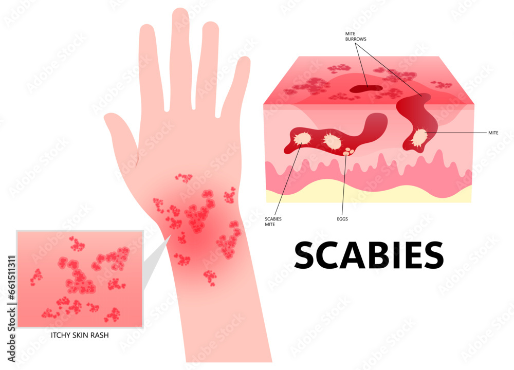 Scabies mites cause hand skin red itching and inflammation Stock ...