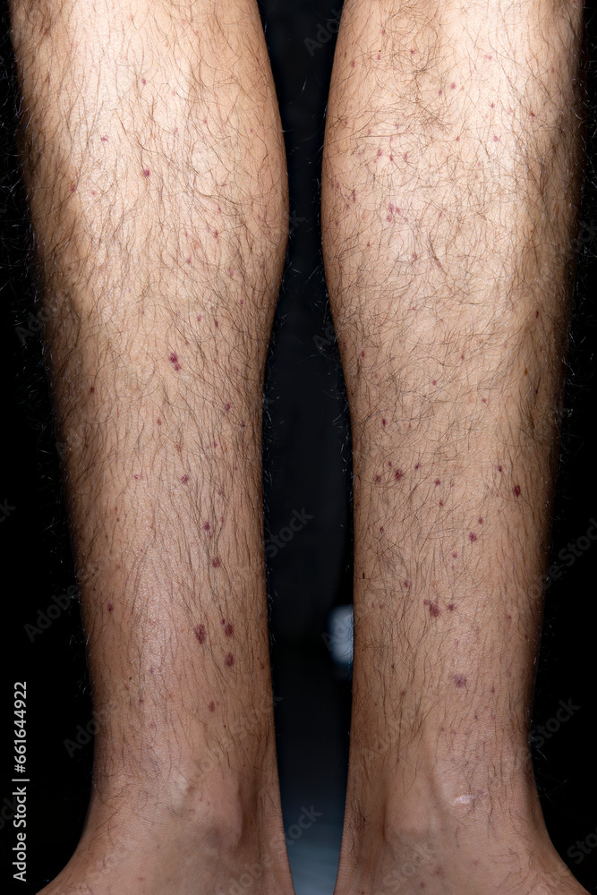Vasculitis. Vasculitis in legs. Small red or purple spots. Post covid ...