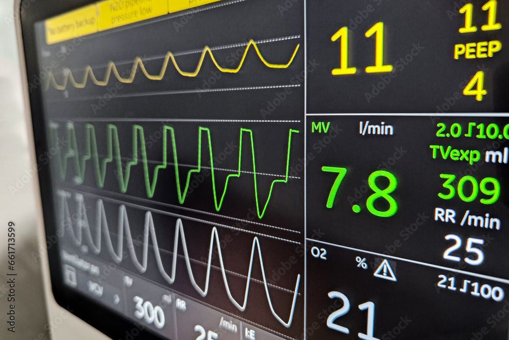 Anesthesia ventilator monitor screen showing waveforms of patient ...
