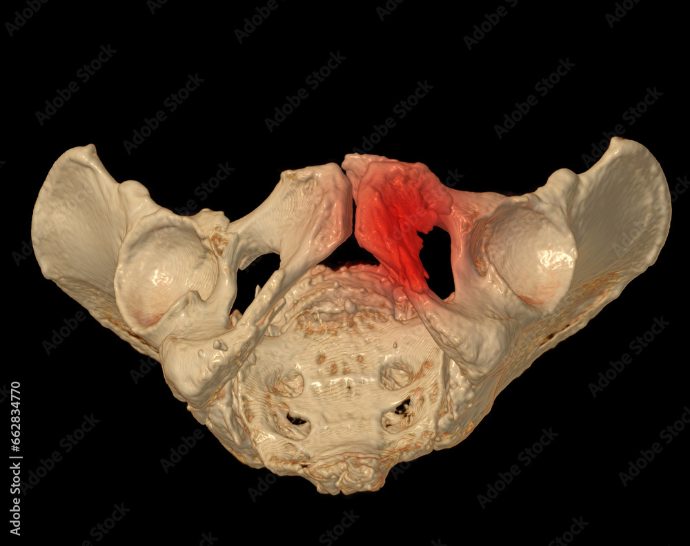 Foto de CT Scan of pelvic bone 3D rendering image showing superior ...