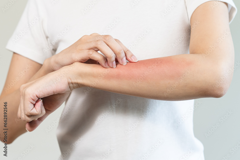 person have red rash on arm from insect bite allergic. Stock Photo ...