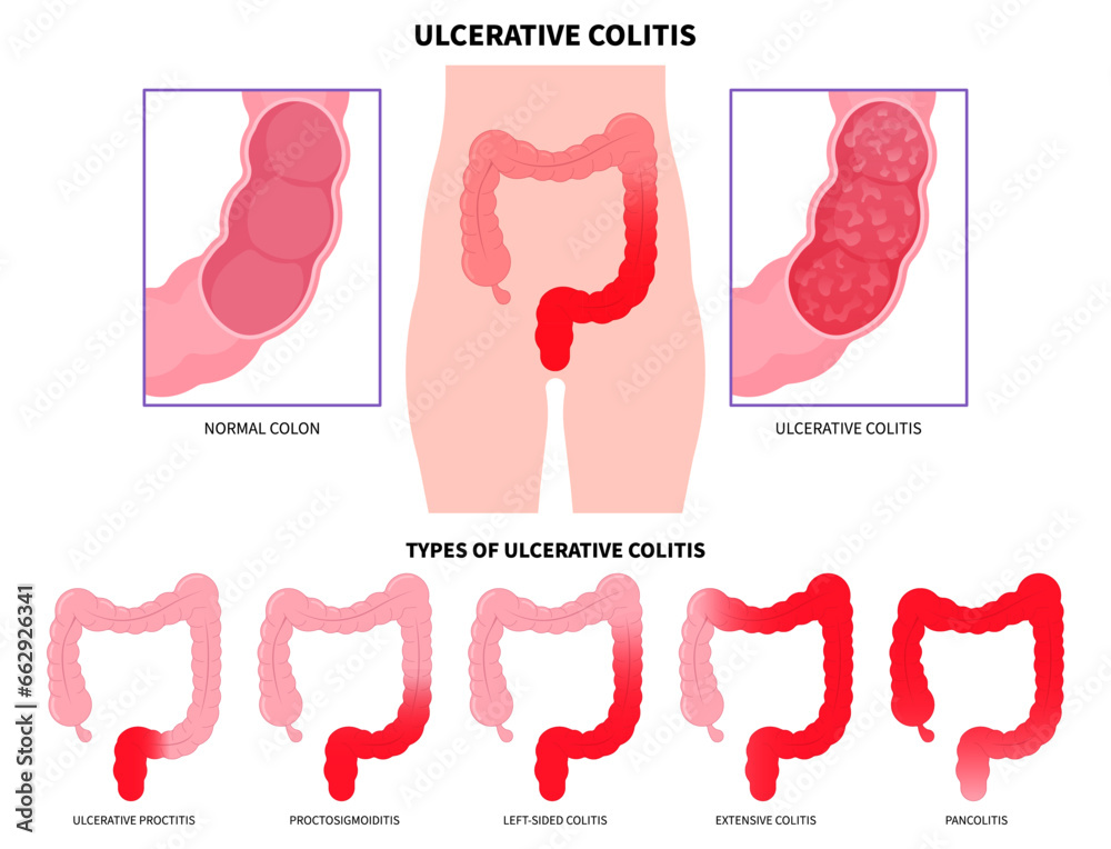 Constipation anatomy of large intestines inflammation with ulcerative ...