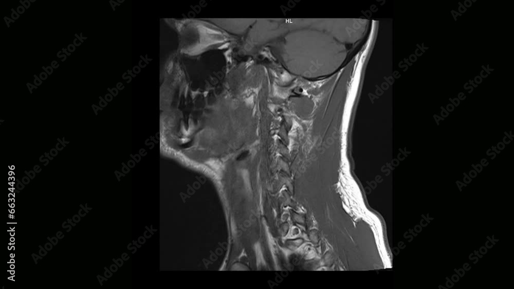 Computed medical tomography MRI scan of the cervical spine of a man ...