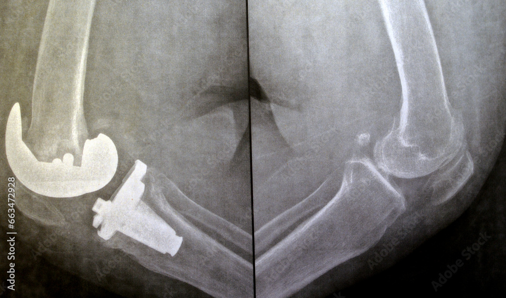 Plain X-ray of knee joints, right side shows total knee replacement ...
