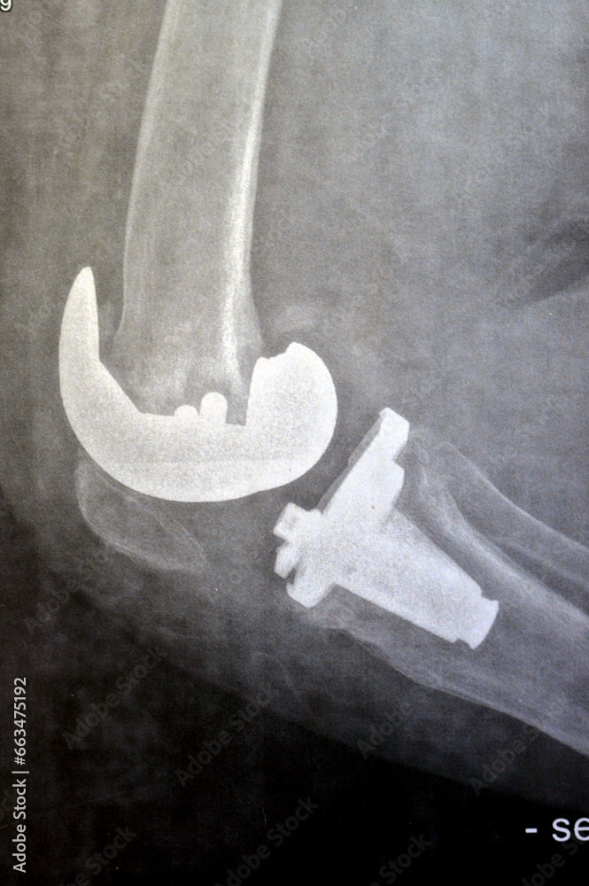Plain X-ray showing Total right knee replacement arthroplasty after ...