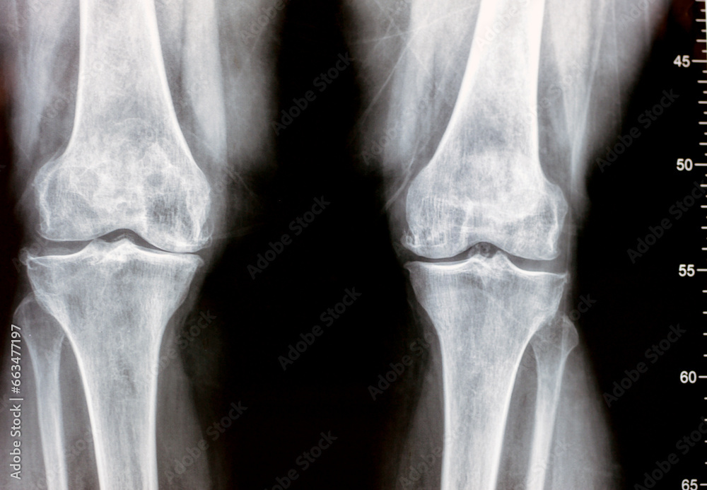 Plain X ray of both knee joints shows apparent joint osteoarthritis ...