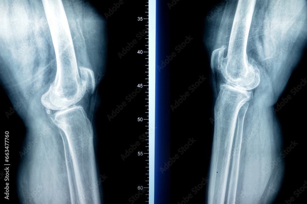 Plain X ray of both knee joints shows apparent joint osteoarthritis ...