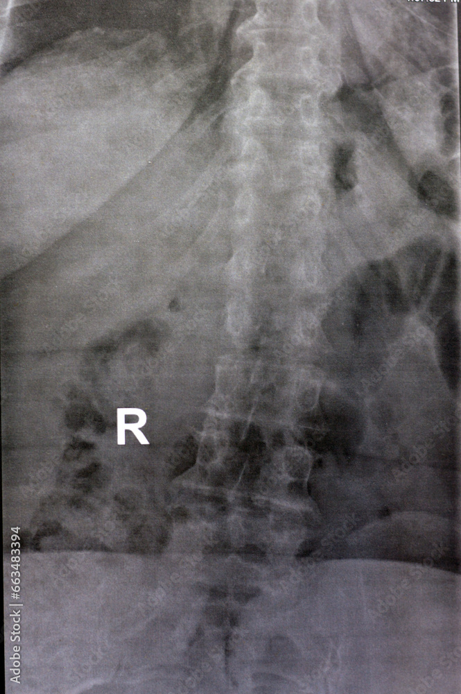Plain x ray of dorsal and lumber spine reveals spondylotic changes ...