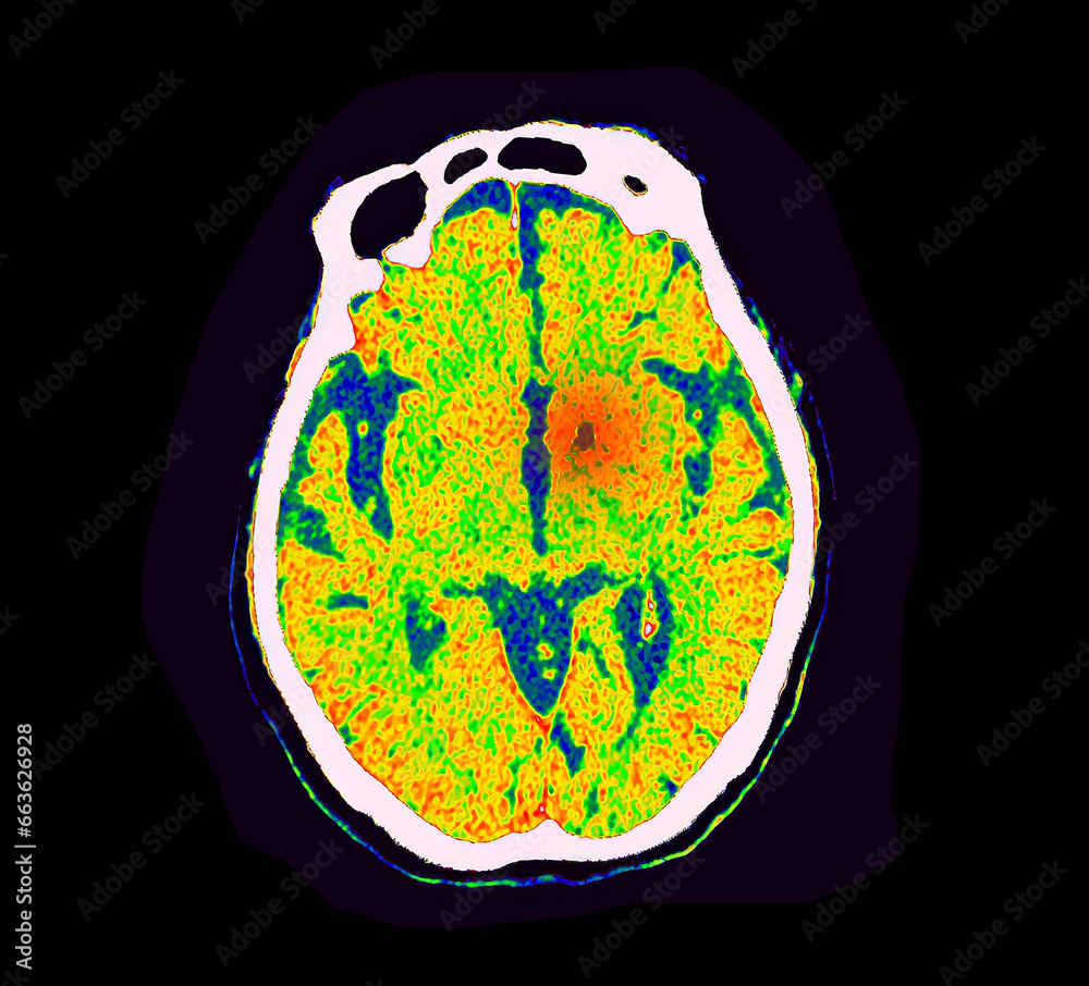 CT Brain Perfusion or CT scan image of the brain axial view showing ...