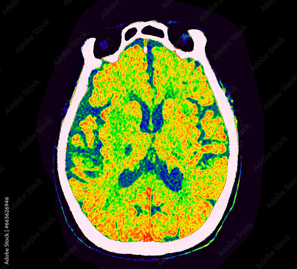 CT Brain Perfusion or CT scan image of the brain axial view showing ...