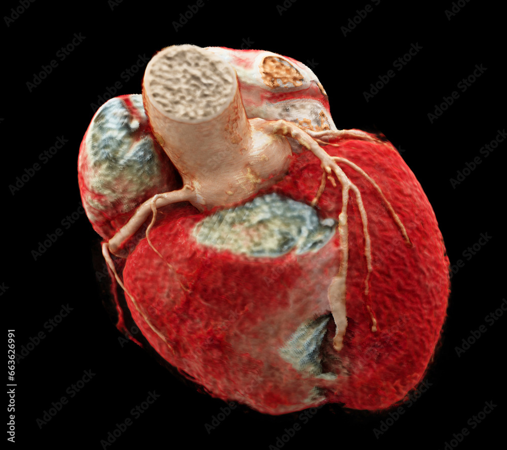 CTA Coronary artery 3D rendering image showing coronary tree and heart ...