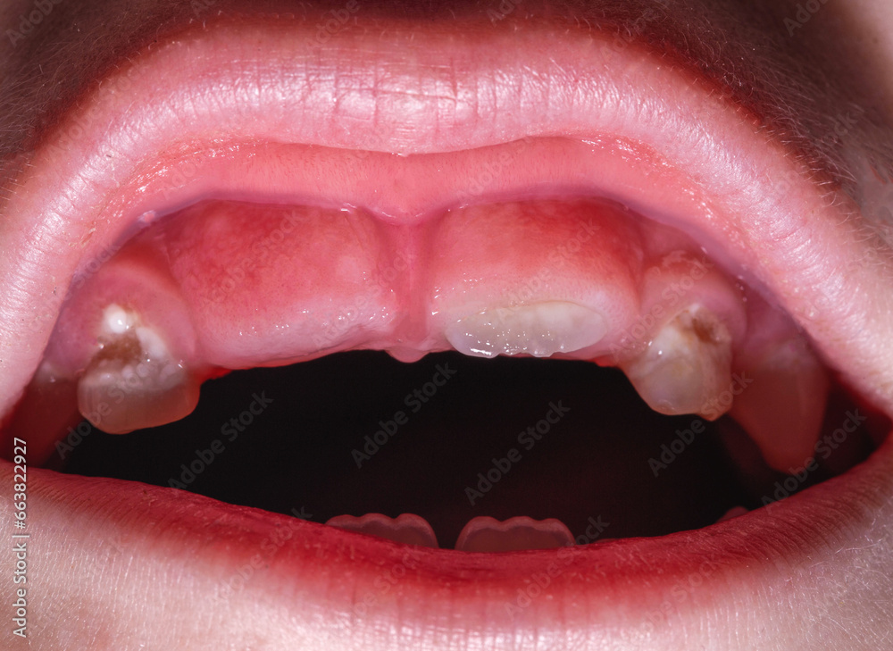 The eruption of a permanent tooth after the loss of a milk tooth in a ...