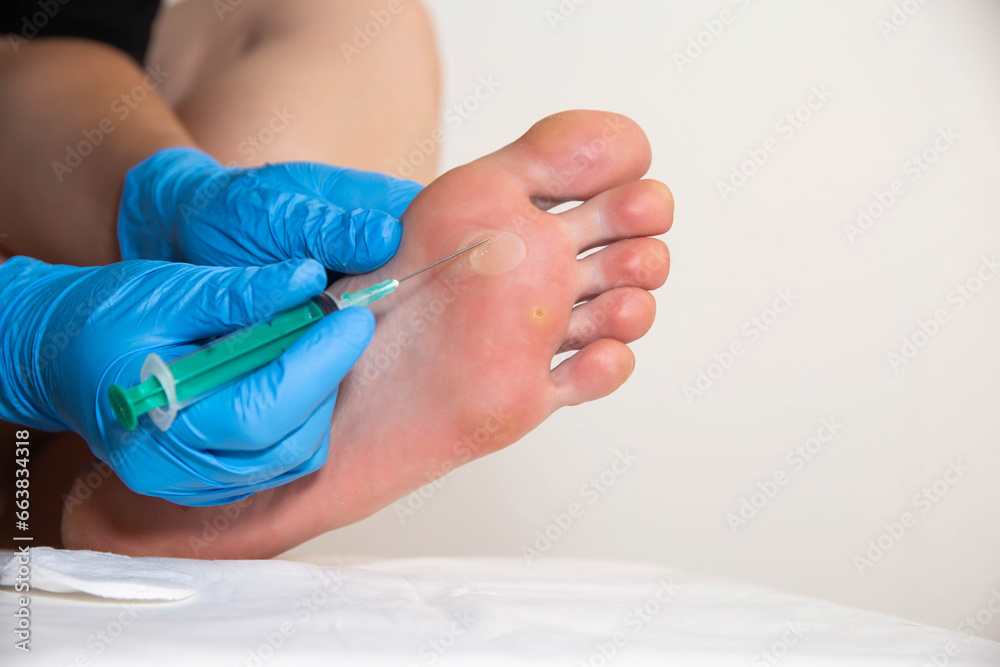 surgery to pierce and remove fluid from a callus on the foot, close-up ...