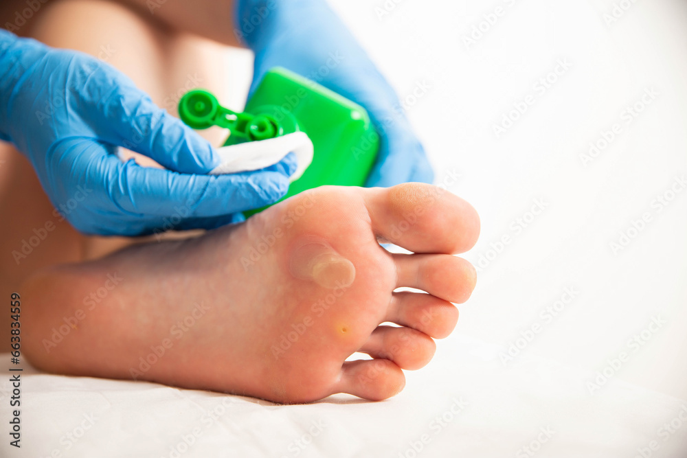 Treatment of a callus on the foot with a special solution after surgery ...