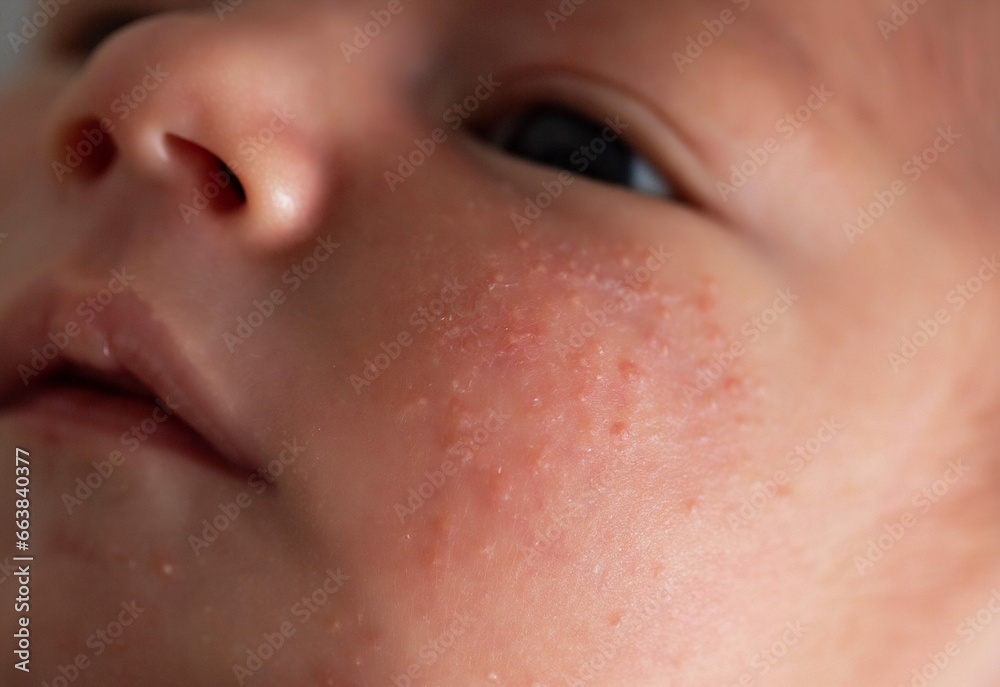 Rash on the face of a newborn baby. The process of formation of the ...