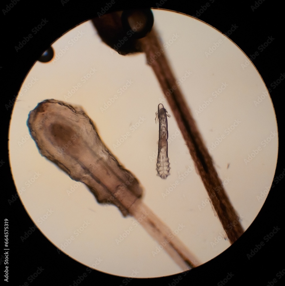 Foto de Demodex folliculorum - parasitic mite on the eyelashes of a ...