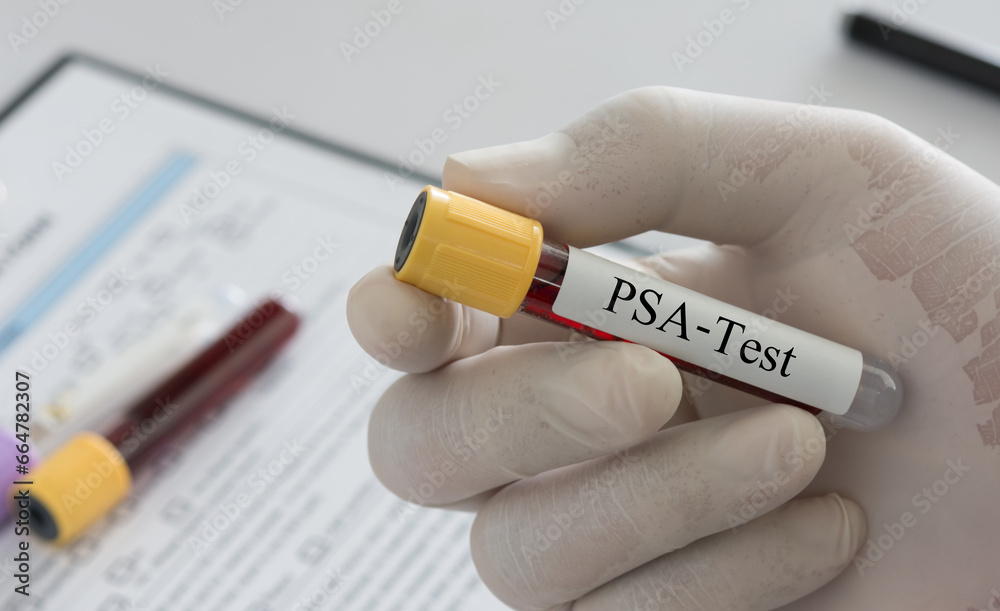 PSA test (Prostate specific Antigen) concept. Doctor holding sample ...