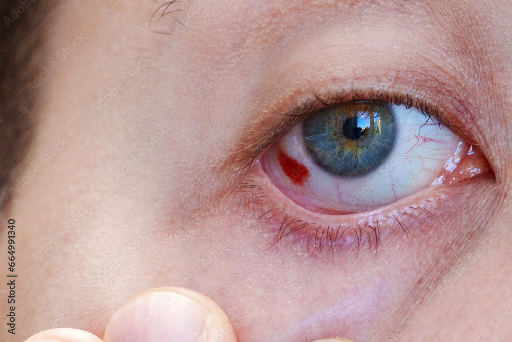 Close up of a bloodshot eye man. Hemorrhage of the eye, rupture of a ...