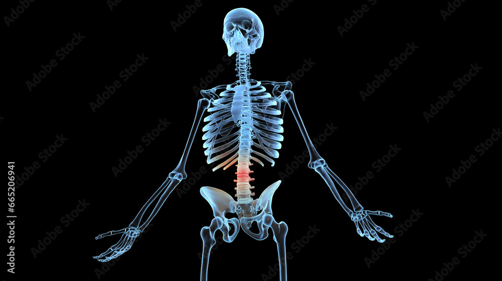 Medical illustration of human skeleton with lumbar fracture injury ...
